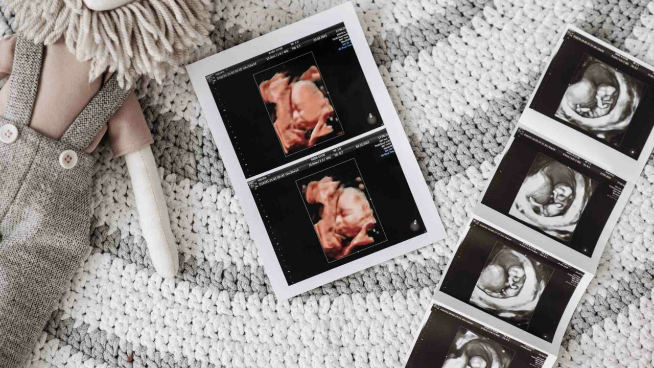 USG 2D: Pemeriksaan Kehamilan Dasar untuk Pantau Janin Awal