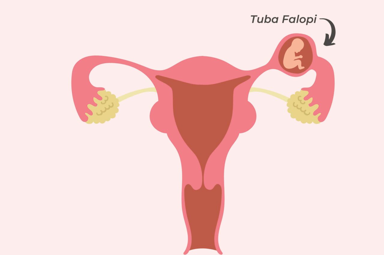 Ketahui Penyebab dan Gejala Kehamilan Ektopik