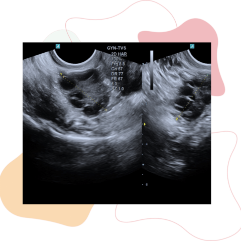 Biaya USG Trans V untuk Promil: Info Lengkap dan Manfaatnya