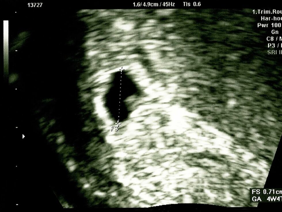 USG Kehamilan 2 Minggu: Apa yang Bisa Terlihat? | Kehamilan Sehat