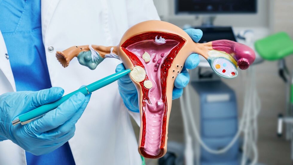 Mengenal Perbedaan Miom dan Kista Apa Saja Gejala dan Penyebabnya