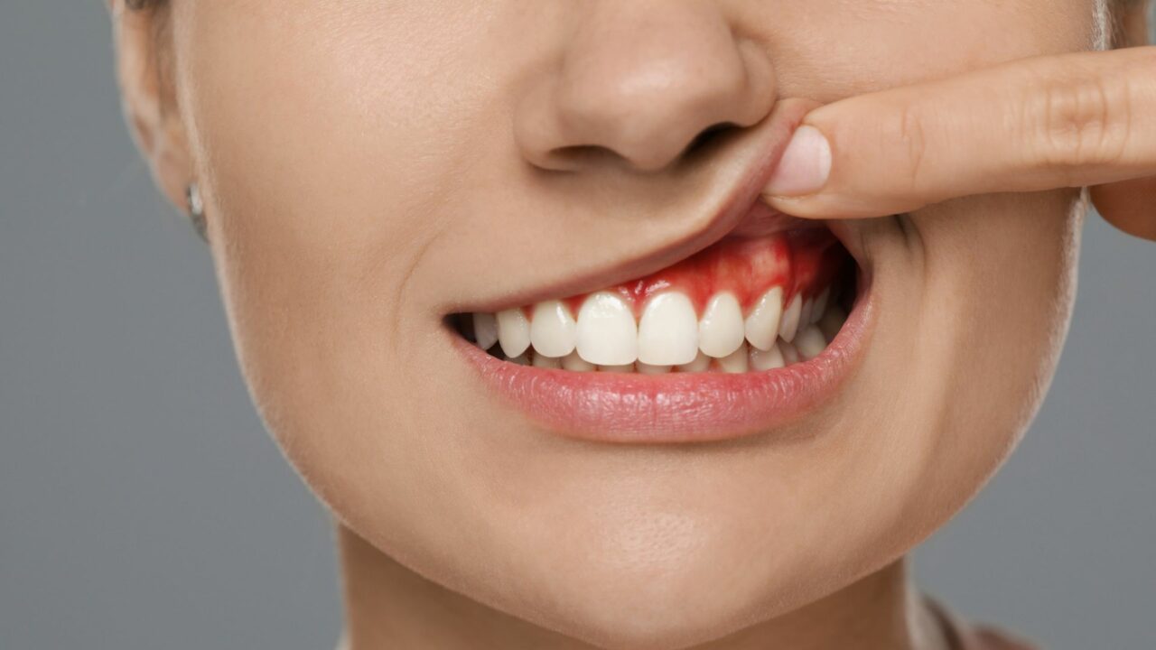 Penyebab Umum Gusi Bengkak dan Berdarah serta Cara Pengobatannya