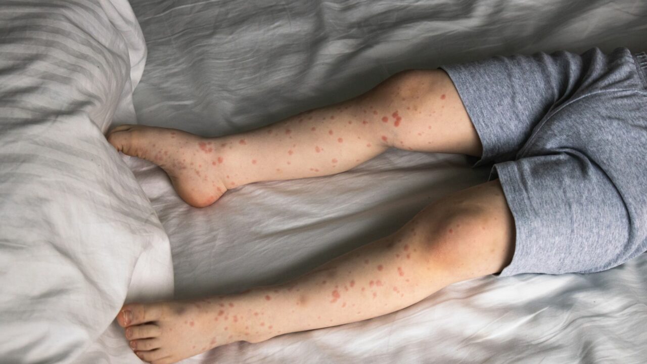 Roseola Infantum pada Bayi: Apa Itu dan Bagaimana Mengatasinya?